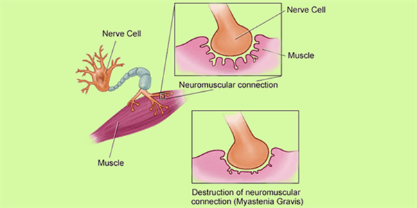 Disorders of Muscular and Skeletal System - Biology for Grade 11 PDF ...