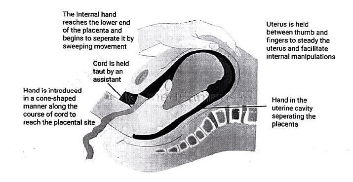 Complications of third stage of Labour - Medical Science Optional Notes ...