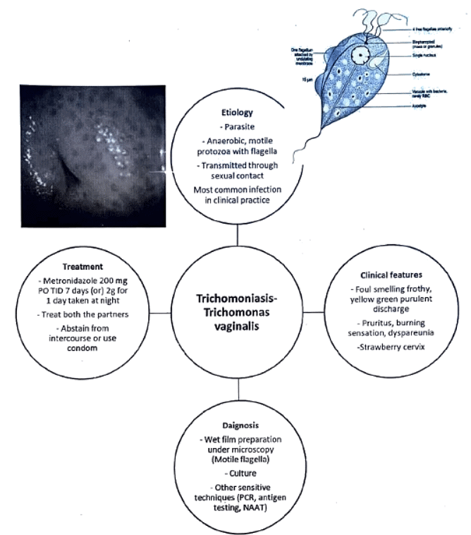 Leucorrhea and STDs - Medical Science Optional Notes for UPSC PDF Download
