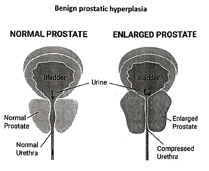 Prostate Gland: Miscellaneous - Medical Science Optional Notes for UPSC ...