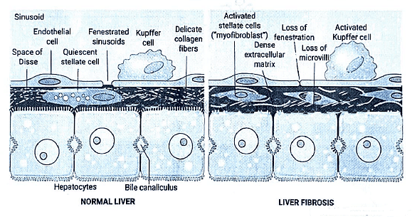 CML: Pathology - Medical Science Optional Notes for UPSC PDF Download