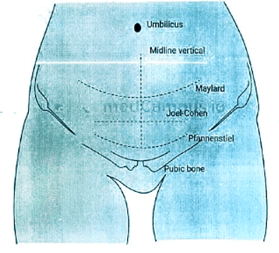 Cesarean section - Medical Science Optional Notes for UPSC PDF Download