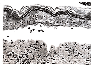 Steven Johnson syndrome (SJS) - Medical Science Optional Notes for UPSC ...