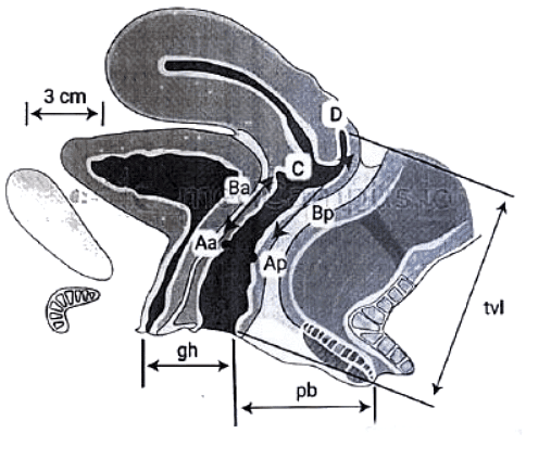 Prolapse of uterus - Medical Science Optional Notes for UPSC PDF Download