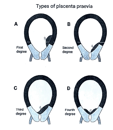 Placenta - Medical Science Optional Notes for UPSC PDF Download